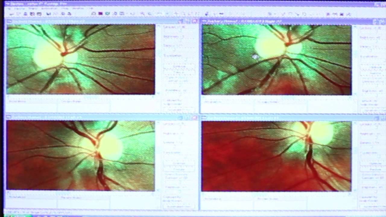 Why choose the Optomap? - YouTube