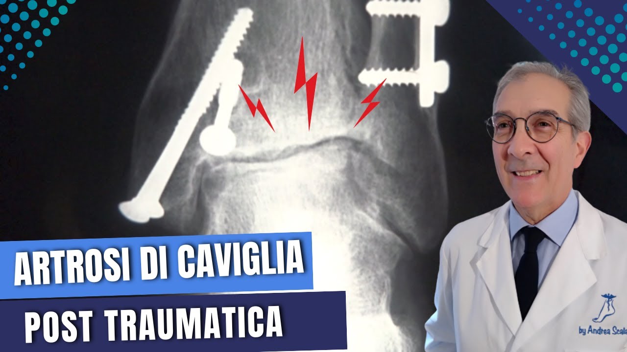 ARTROSI DELLA CAVIGLIA cause, sintomi e cure | Artrosi post traumatica ...