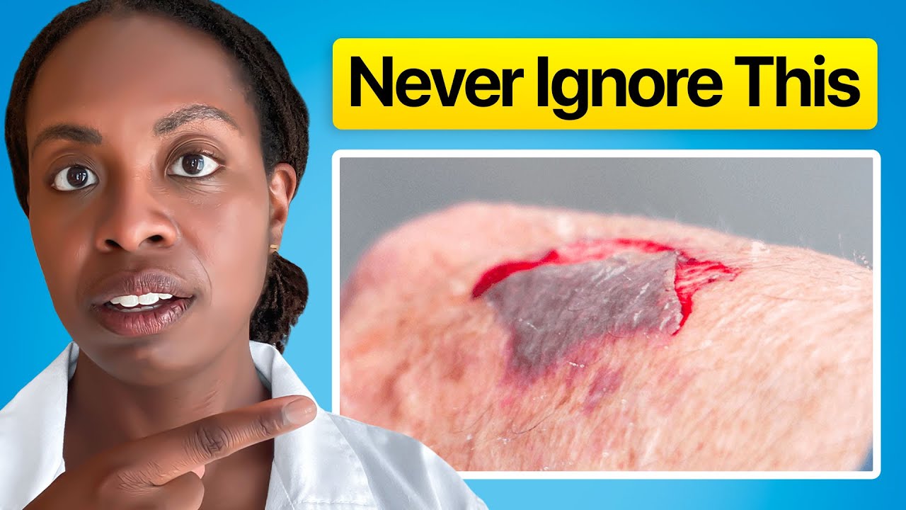 Skin Tears: The Small Wounds That Cause BIG Problems - YouTube
