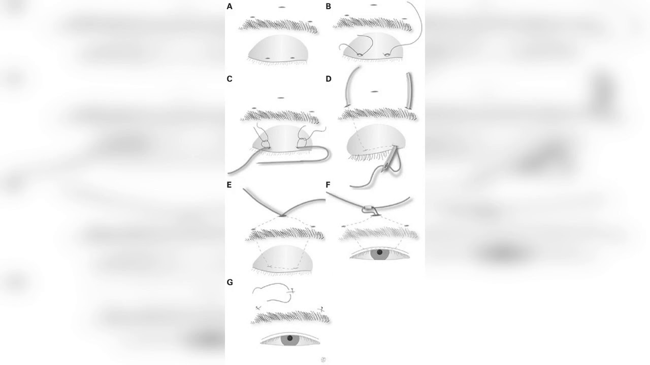 Frontalis sling surgery for ptosis - YouTube