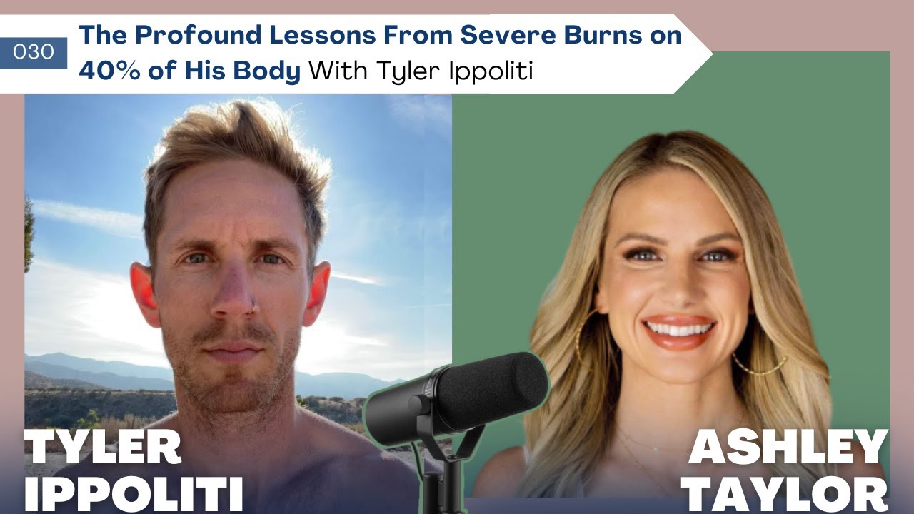The Profound Lessons From Severe Burns on 40% of His Body With Tyler ...