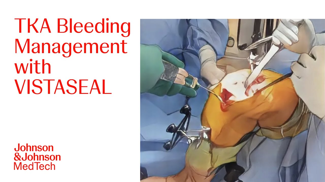 How VISTASEAL Helps Control Bleeding in Total Knee Replacement Surgery ...