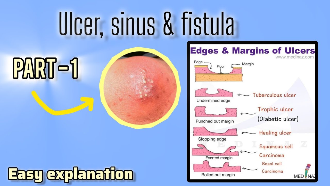Classification of Ulcers | arterial, venous, trophic, traumatic ulcers ...