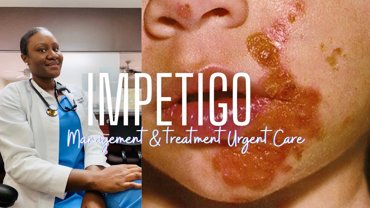 How to Diagnose IMPETIGO | Management & Treatment | Urgent Care Setting ...
