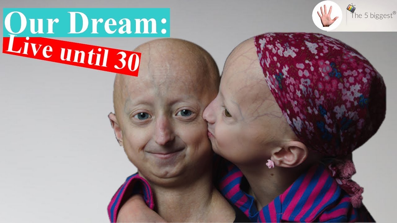 Rarest Disease Unique Case Of Brother And Sister With Progeria Dream