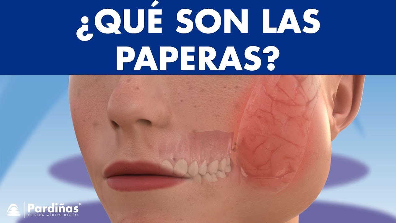 PAPERAS, qué son?, signos y sintomas y tratamiento - YouTube