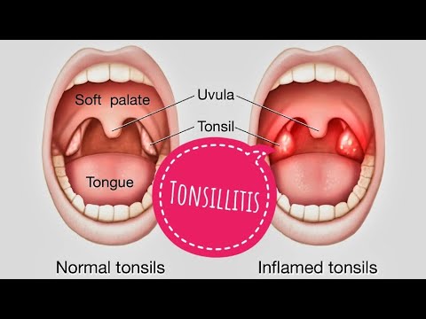 TONSILLITIS : Causes, Treatment & Prevention | About Health - YouTube