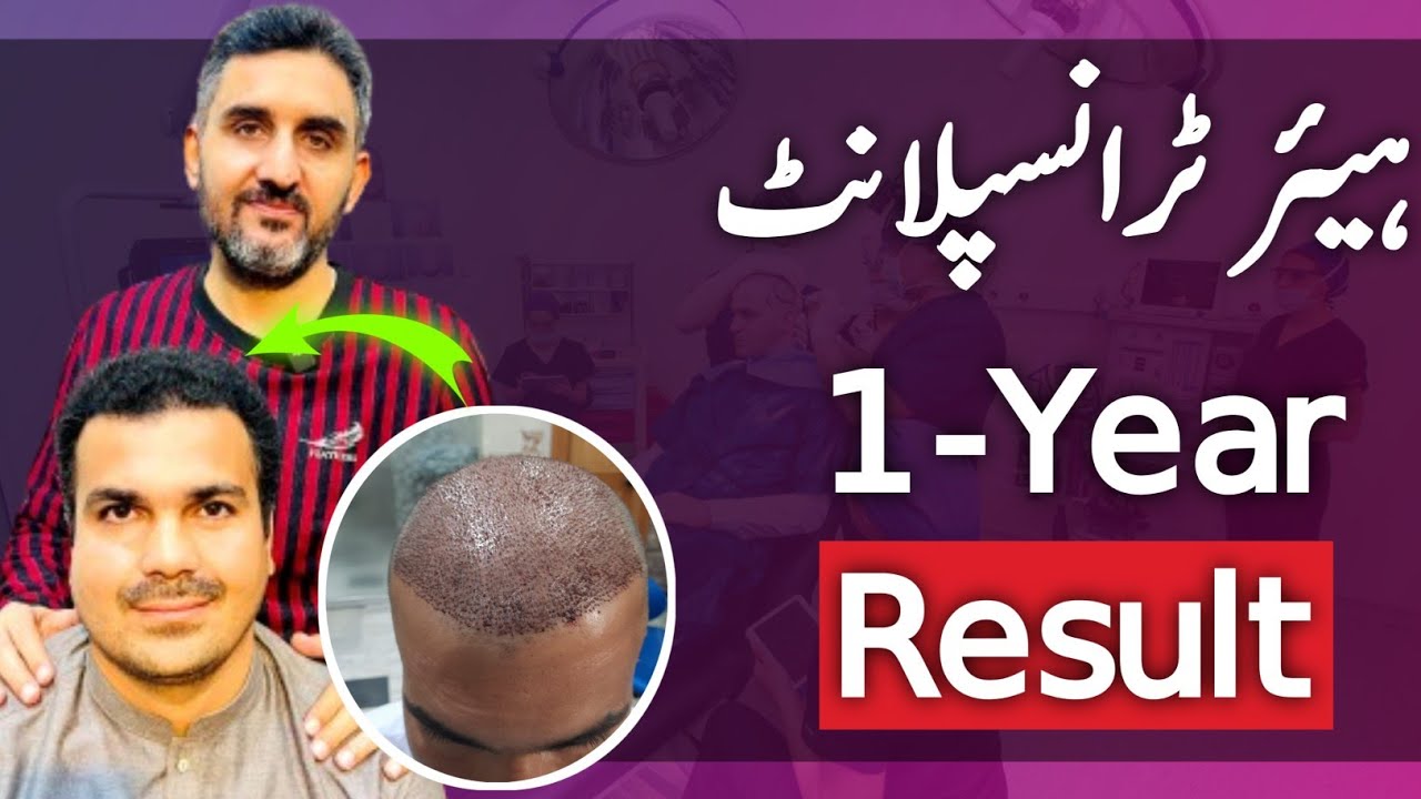 Transformative Hair Transplant Results: FUE Hair Transplant with Dr ...