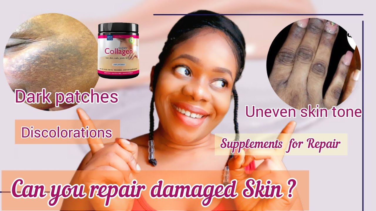 How to Repair Damaged Skin caused by over-use of skin lightening ...
