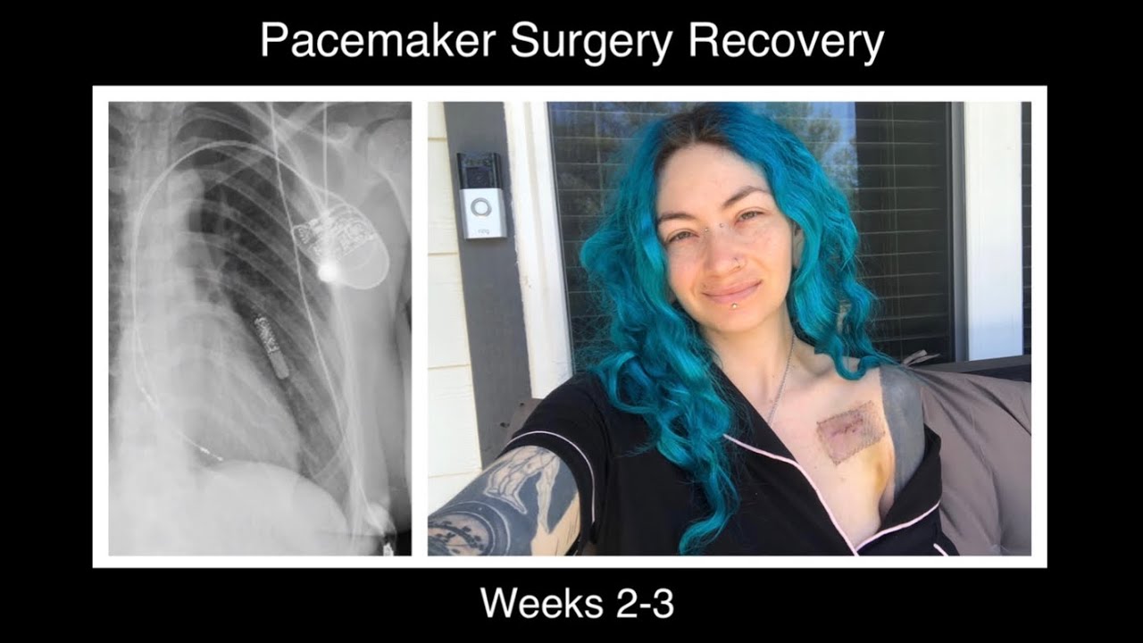 My Second and Third Weeks of Having a Pacemaker (Surgery Recovery ...