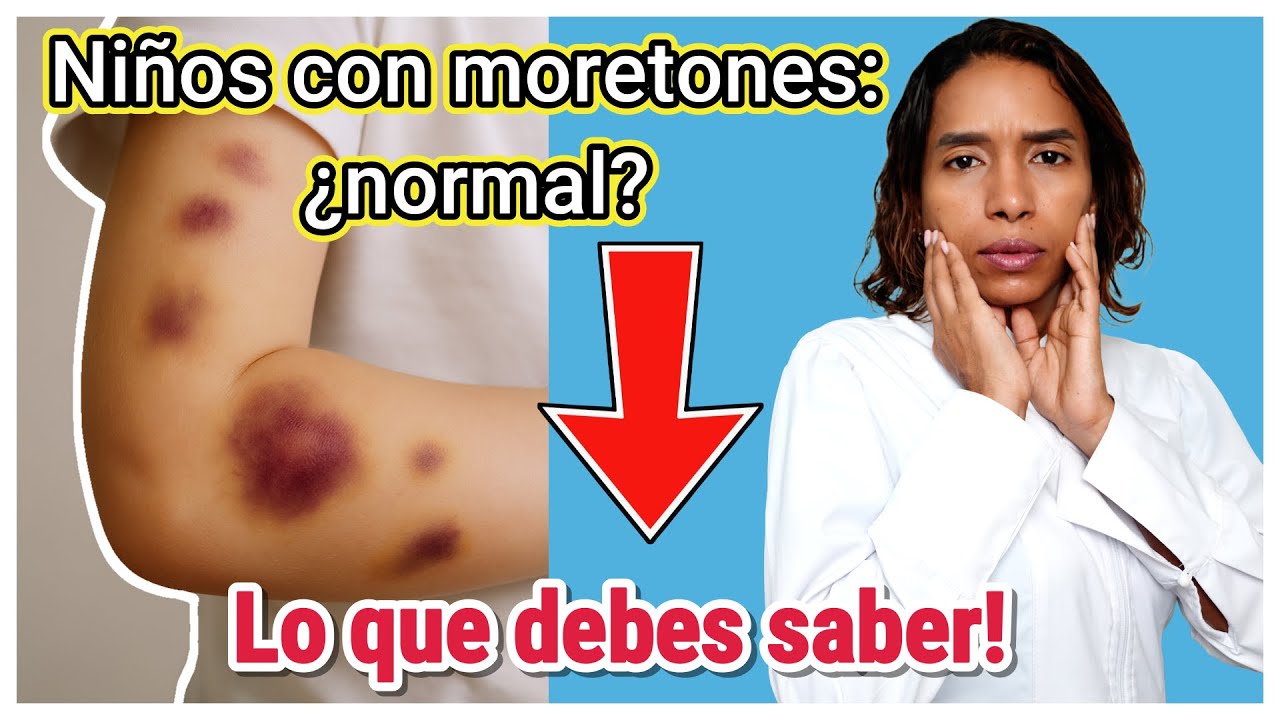 Moretones y sangrados cuándo deben preocuparte #MoretonesEnNiños # ...