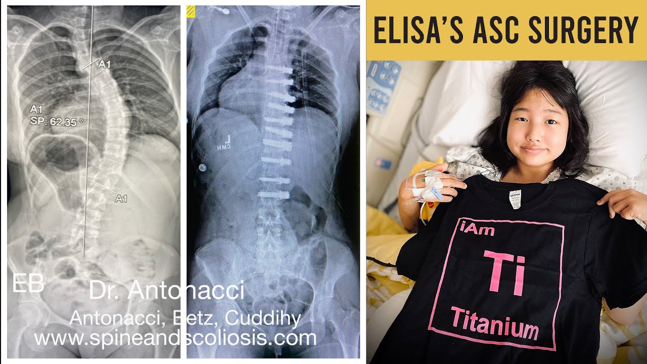 Elisa's ASC Surgery at Saint Peter's University Hospital - YouTube