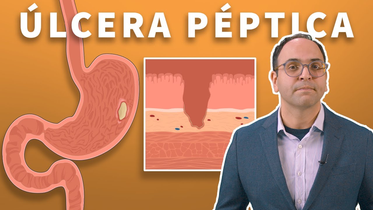 Úlcera péptica: Un paciente pregunta al médico de Stanford sobre la ...