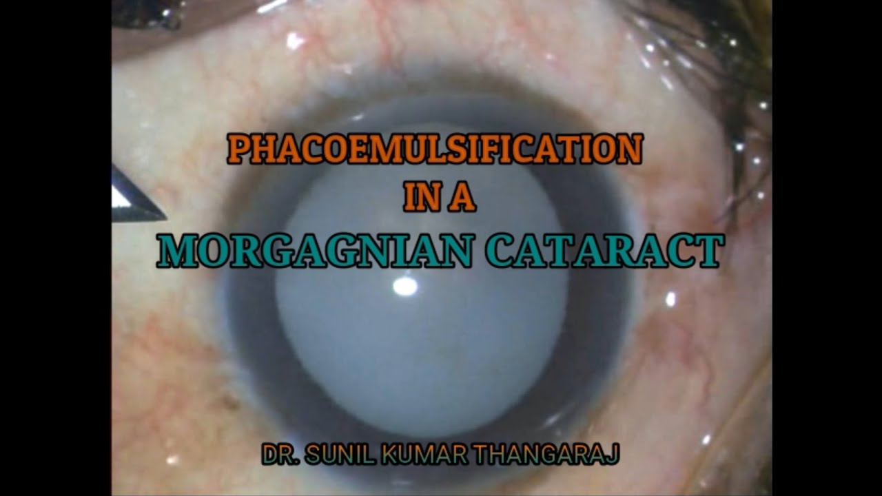 Phacoemulsification in a hard Morgagnian Cataract - YouTube