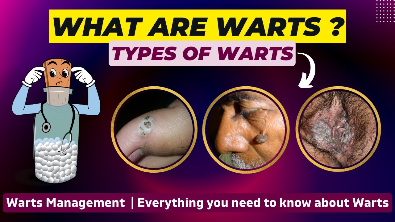What is Warts | Types of warts | Management of Warts | Everything you ...