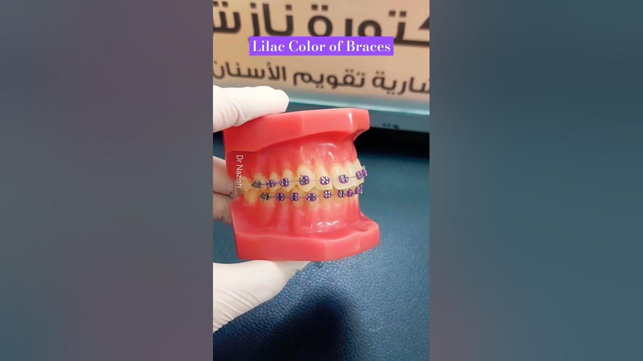 Lilac Color Of Bracesdr Nazish Youtube