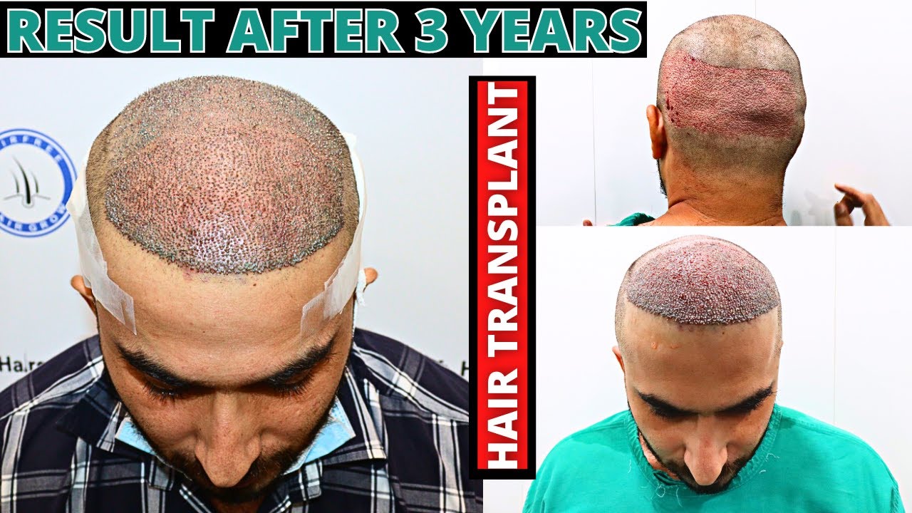 Hair Transplant Result after 35 Months | hair transplant fail | Born ...