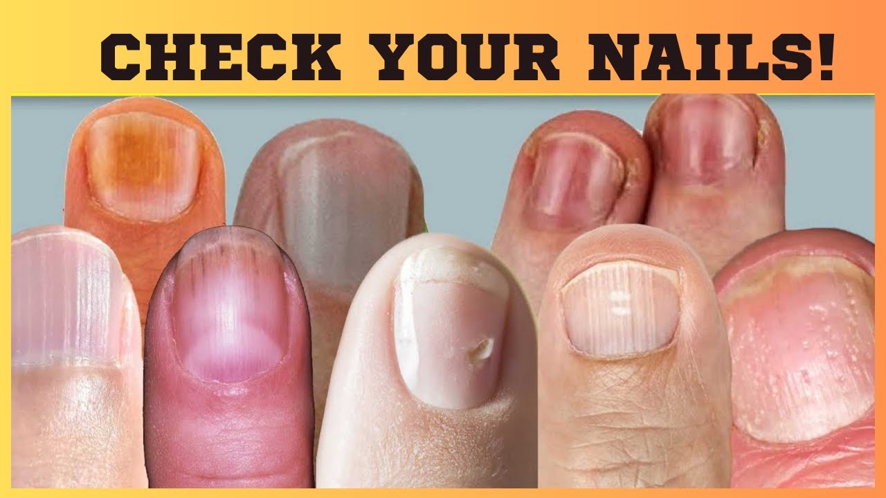 9 Things Your Nails Can Tell You About Your Health - YouTube
