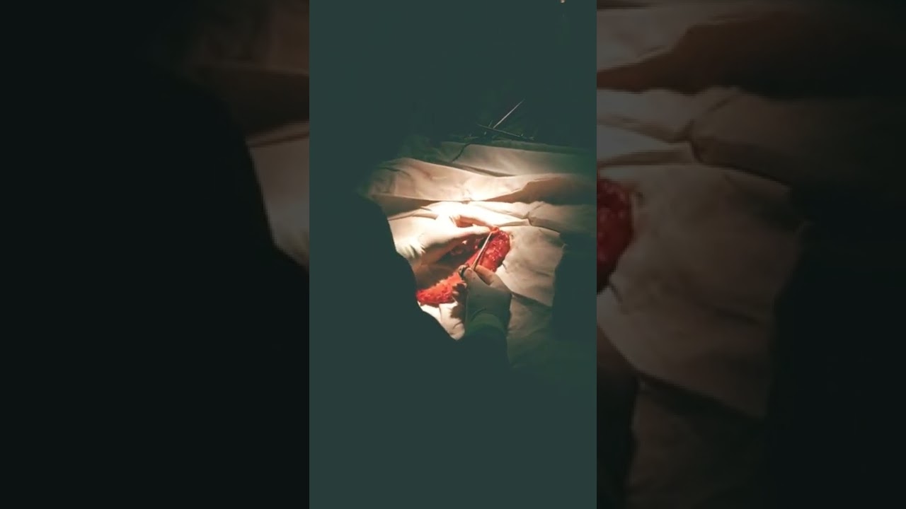 Belsey's Pad Of Fat+ Sleeve Gastrectomy - YouTube