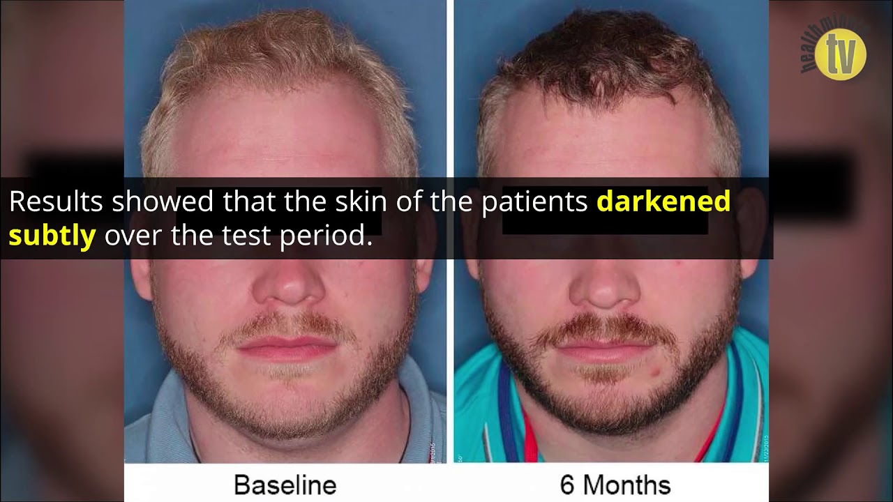 New Therapy Increases Melanin in Patients with Albinism - YouTube