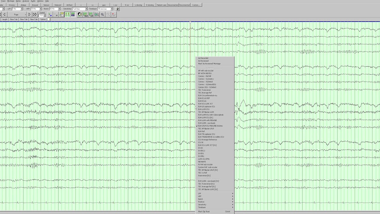 Left temporal epileptiform activity - YouTube