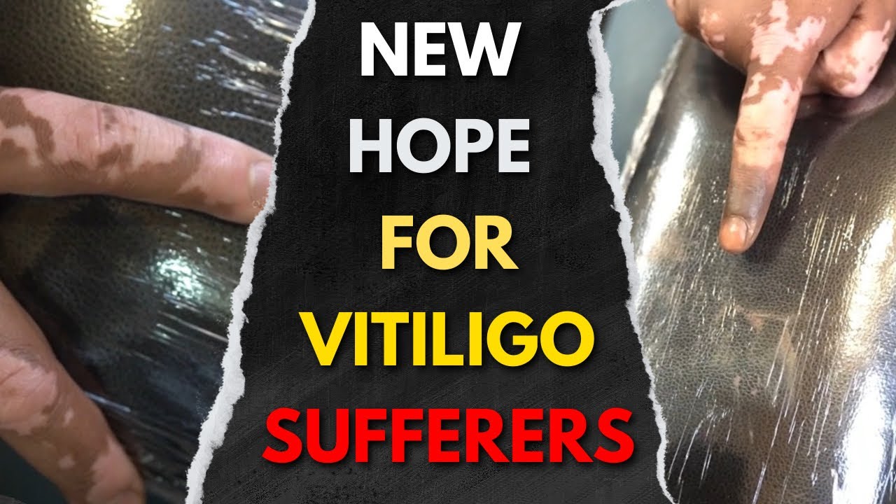 Stop Vitiligo Progression! Best Treatment Methods to Try This | Machu ...