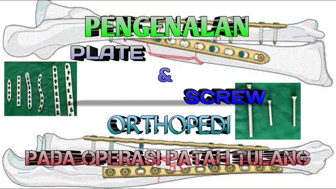 PENGENALAN PLATE DAN SCREW ORTHOPEDI (OPERASI PATAH TULANG) - YouTube