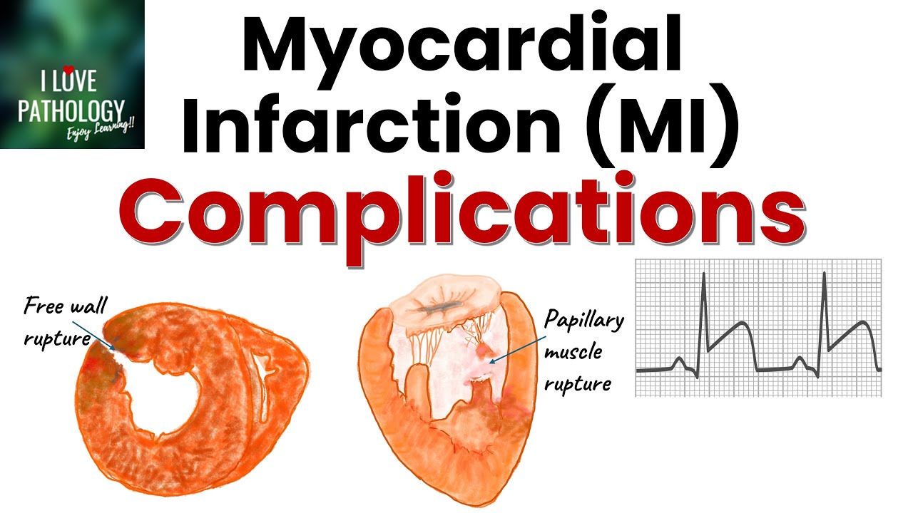 MYOCARDIAL INFARCTION | Complications | Ischemic heart disease | part 6 ...