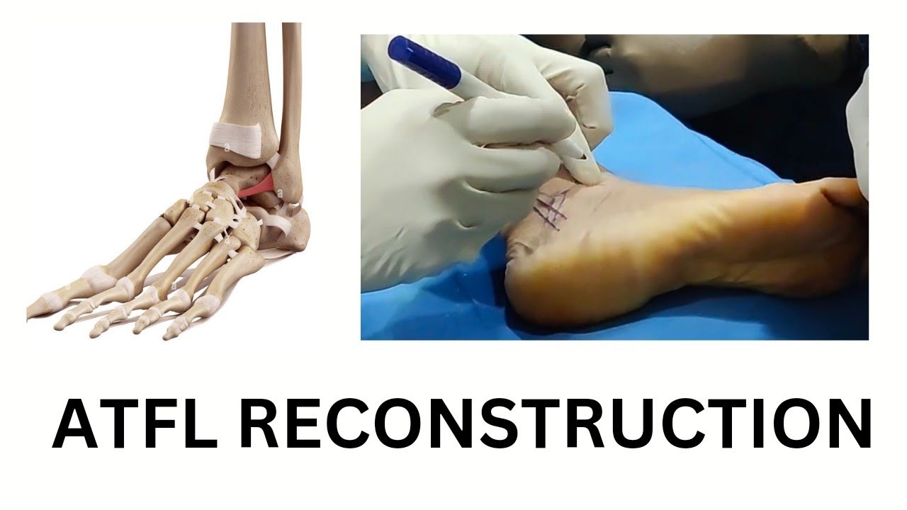 ATFL reconstruction: Modified Brostrum repair - YouTube