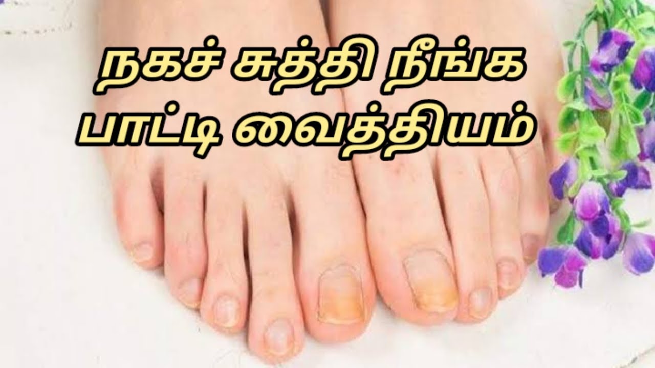 நக சுத்தி குணமாக|naga suthi patti vaithiyam tamil|Nail fungus home ...