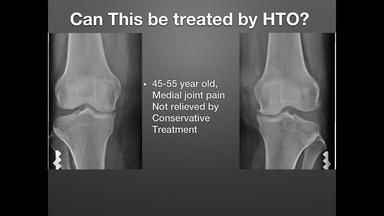 High Tibial Osteotomy - Misconceptions & Planning - YouTube