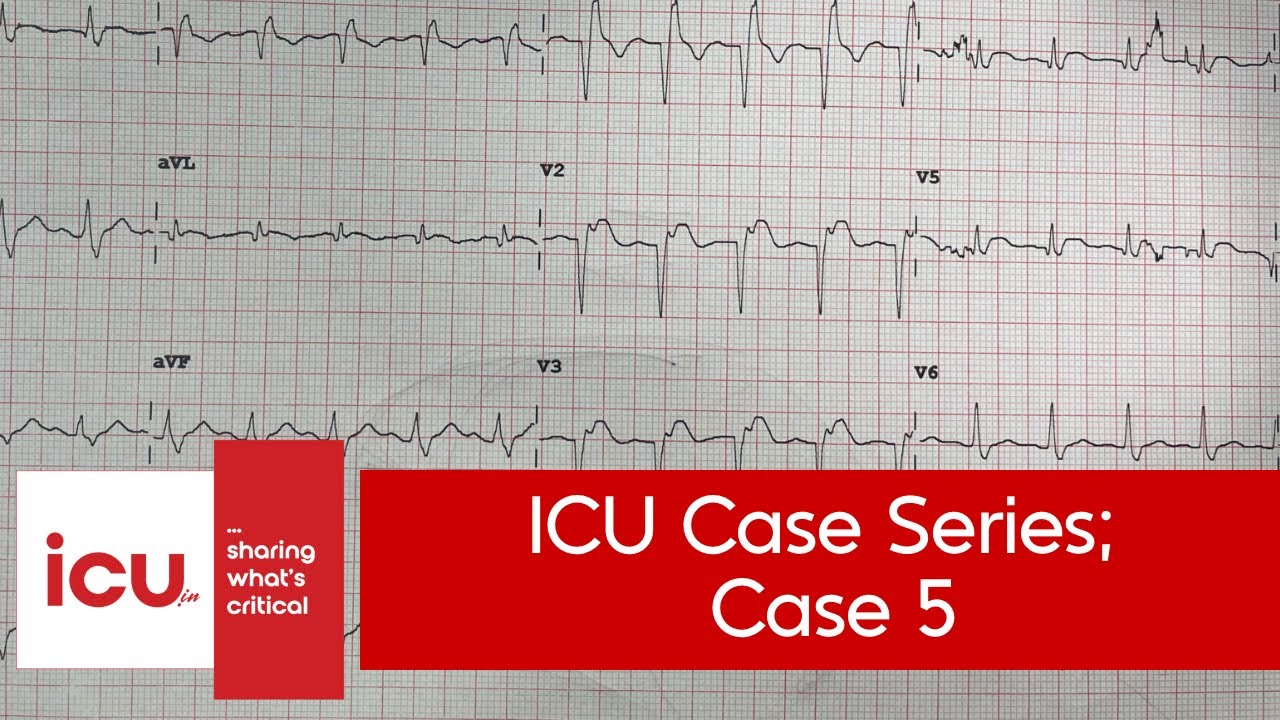 #icucase 5: Cardiology, qRBBB in ACS, ? importance - YouTube