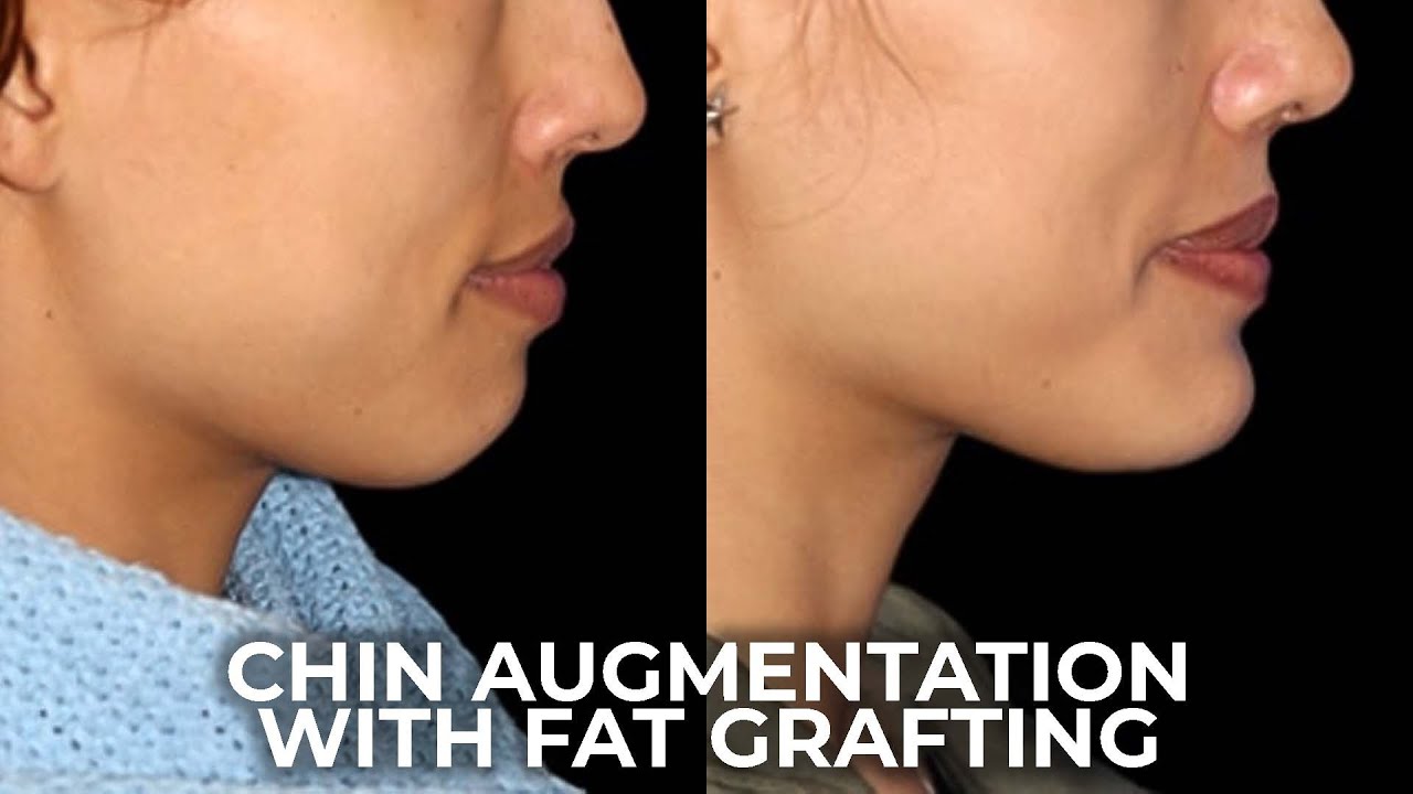 Chin Augmentation with Fat Grafting | A Natural Approach to Facial ...