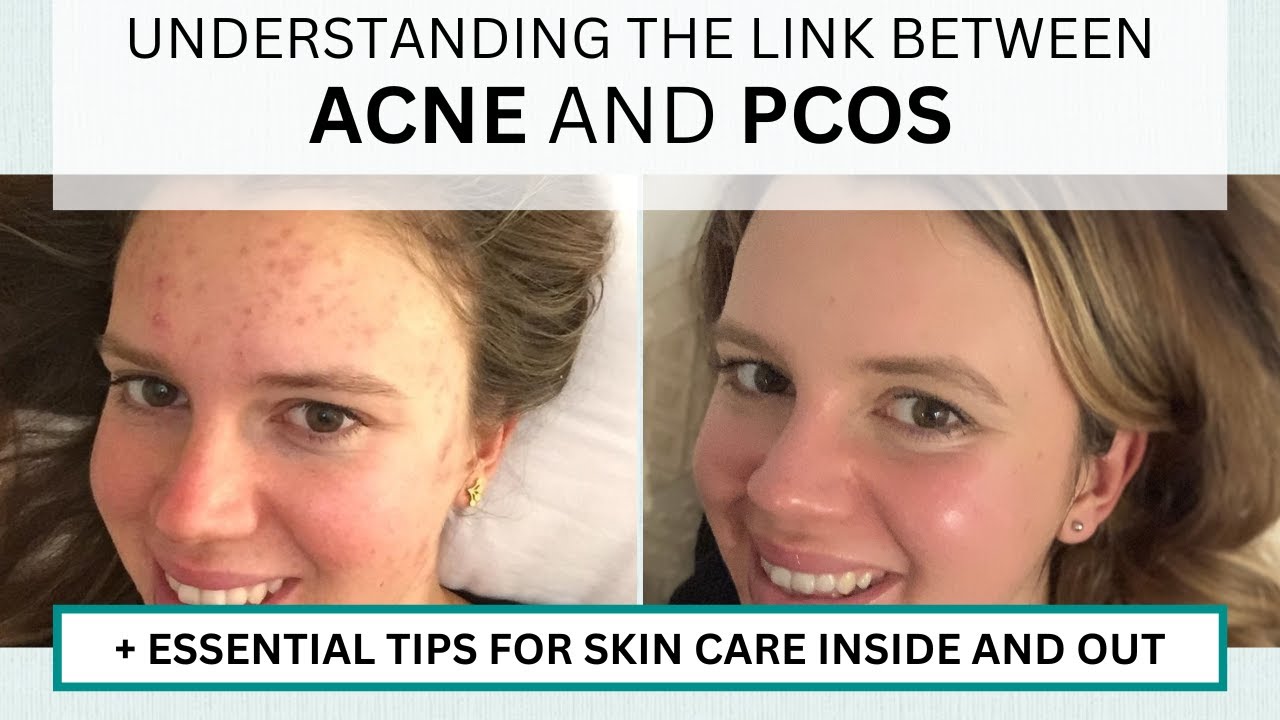 Why do I have Acne in PCOS? And what to do about it: Tips for Skin Care ...