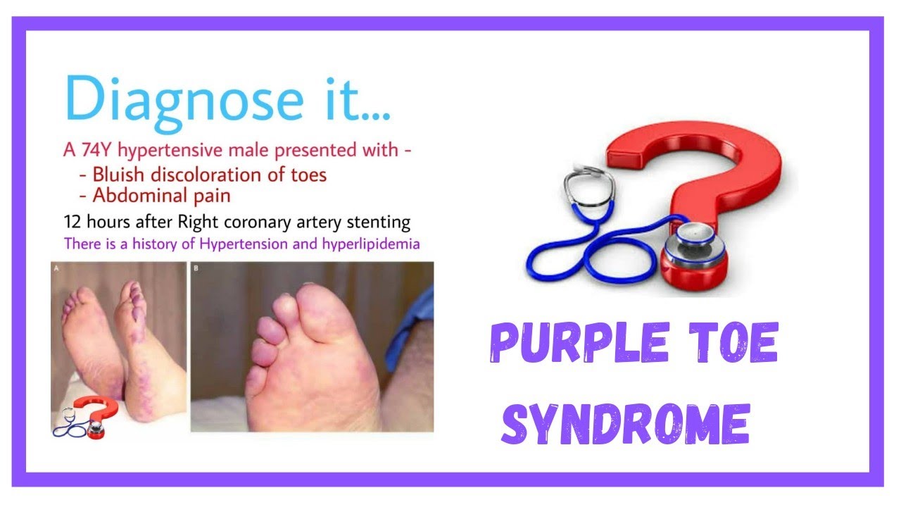 Purple toes- Purple toe syndrome it is. - YouTube
