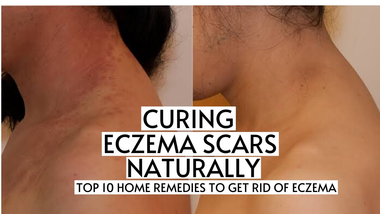 Natural Cures to get rid of Eczema Scars & Black Heads: Top 10 Home ...