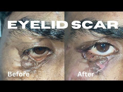 scar revision surgery around eye | Scar revision surgery in Ranchi ...