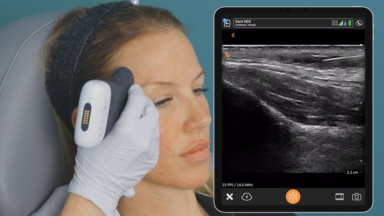 Ultrasound Guided Temple Injection Right Side - YouTube