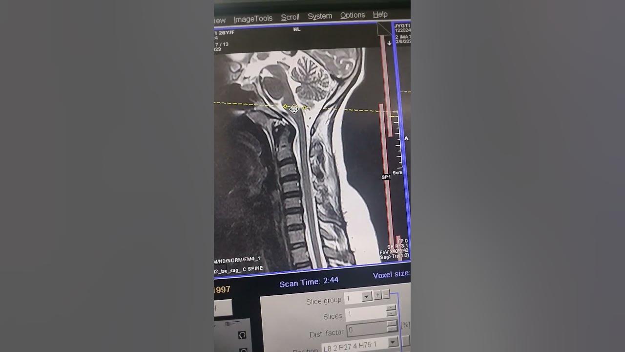 Mri Cv Junction Planning Sequence Protocols Youtube