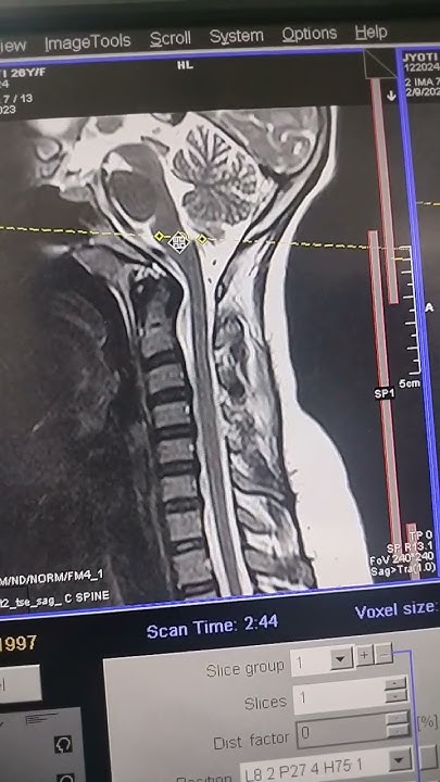 Mri Cv Junction Planning Sequence Protocols Youtube