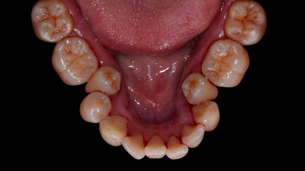 덧니 교정 치료 과정 - 작은 어금니 발치, 클리피씨 교정 장치 | orthodontic treatment process ...