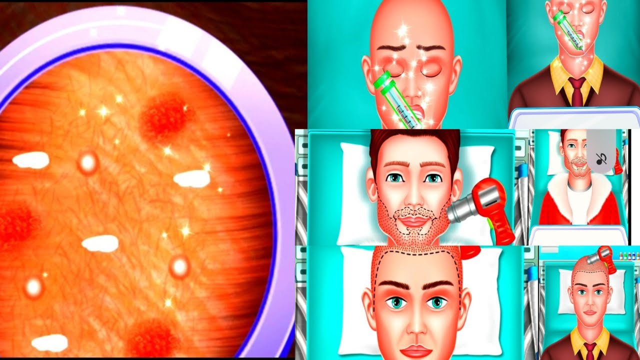 Mens Hair transplant procedure animation | hair transplant surgery ...