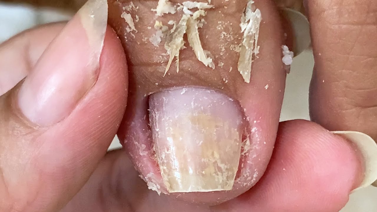 Clean The Skin And Remove The Corner Of The Nail - Ingrown Toenail ...