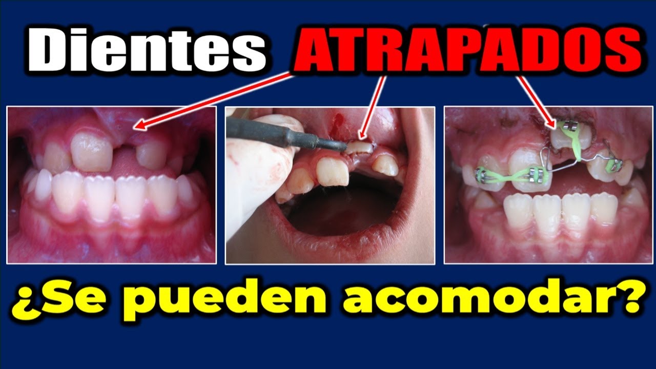 DIENTES O MOLARES RETENIDOS INCLUIDOS O IMPACTADOS / CAUSA DIAGNÓSTICO ...