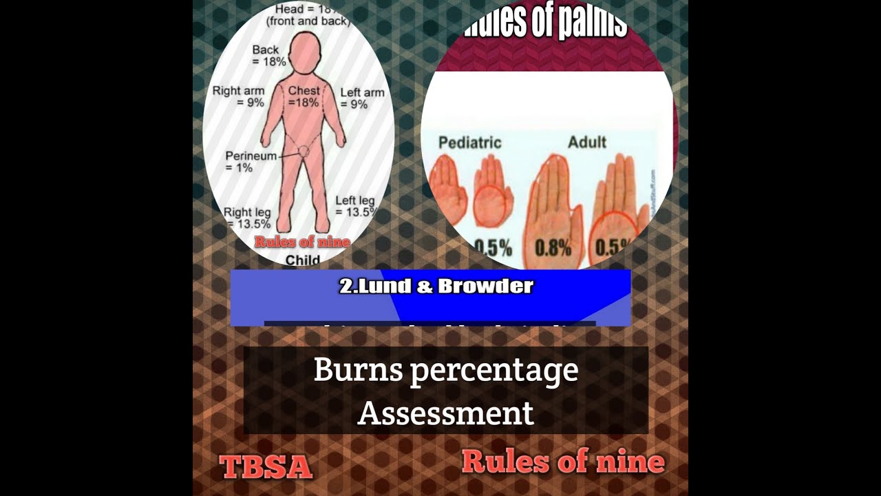 Rules of nine,LundBrowder method,palmer method-Burn assessing,percentage calculation - YouTube