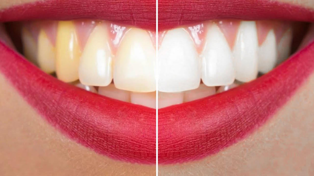 How To Whiten Teeth In Photoshop – Tutorial - YouTube