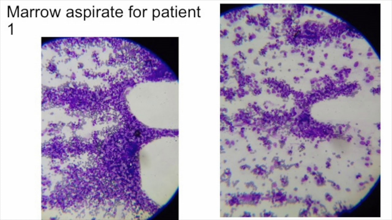 (Peripheral Blood Film) PBF - YouTube