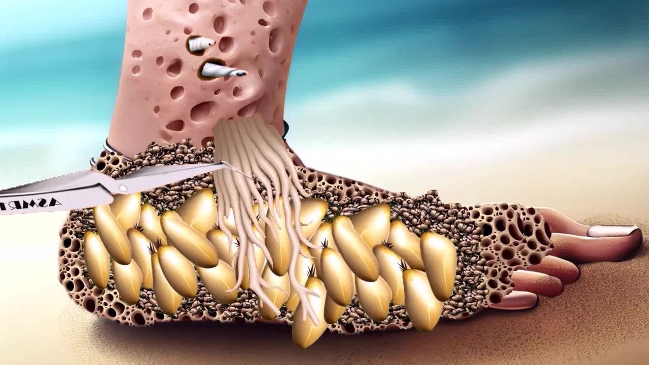 ASMR ANIMATION Foot Maggots Treatment - YouTube