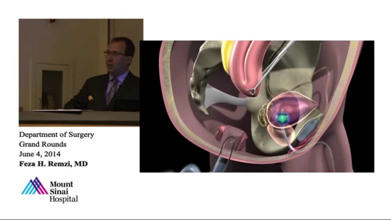 Quality Improvement in IBD Surgery - YouTube