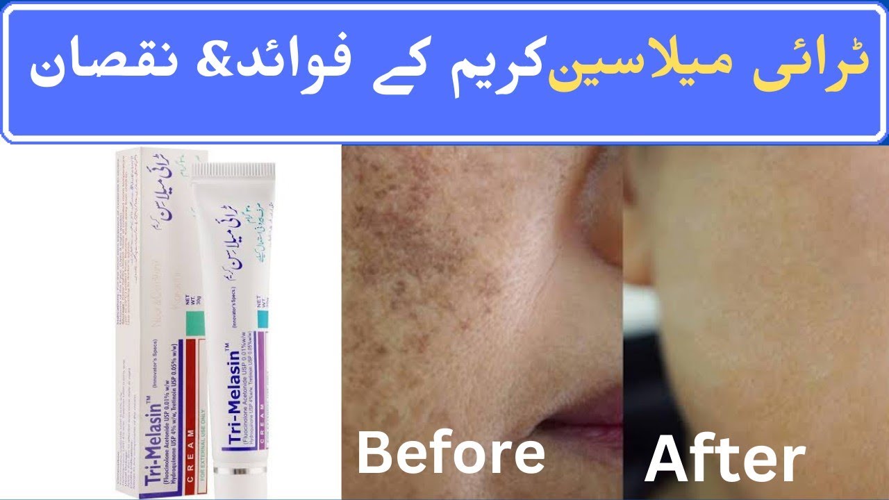 Tri melasin cream uses, side effect and precaution/Tri melasin cream ...